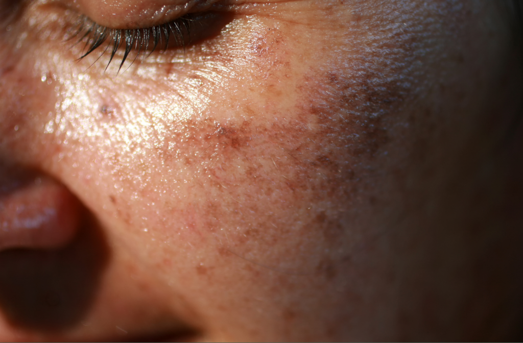 How to get rid of my Age Spots, Liver Spots, and Sun Spots?